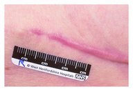 Hypertrophic scars and keloids - Knowledge @ AMBOSS