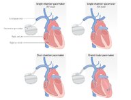 Cardiac implantable electronic devices - Knowledge @ AMBOSS