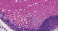 Myocardial infarction - Knowledge @ AMBOSS