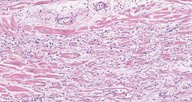 Myocardial infarction - Knowledge @ AMBOSS