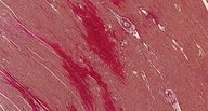 Myocardial infarction - Knowledge @ AMBOSS