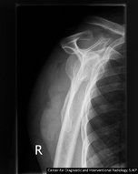 Acromioclavicular joint injury - Knowledge @ AMBOSS