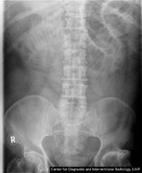 Bowel obstruction - Knowledge @ AMBOSS