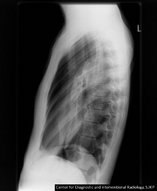 Pneumothorax - Knowledge @ AMBOSS