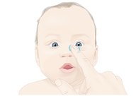 Diseases of the lacrimal apparatus - Knowledge @ AMBOSS