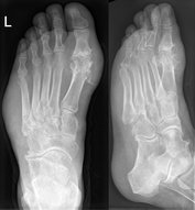 Gout and hyperuricemia - Knowledge @ AMBOSS