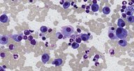 Multiple myeloma - Knowledge @ AMBOSS