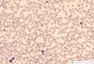 Erythrocyte morphology and hemoglobin - Knowledge @ AMBOSS