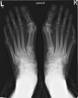 Toe deformities - Knowledge @ AMBOSS