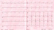 Risk of progression to complete heart block : low, as the block results ...