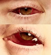 Traumatic eye injuries - Knowledge @ AMBOSS