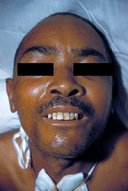 Tetanus - Knowledge @ AMBOSS