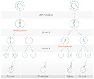 Trisomy 18 (Edwards syndrome)