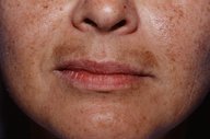 Hyperpigmentation disorders - Knowledge @ AMBOSS