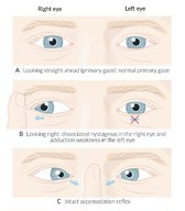 Ocular motility disorders and strabismus - Knowledge @ AMBOSS