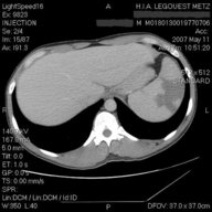 Splenic injuries - Knowledge @ AMBOSS