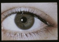 Wilson disease - Knowledge @ AMBOSS