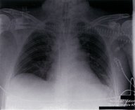 Atelectasis - Knowledge @ AMBOSS