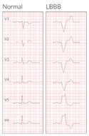 Ventricular tachycardia - Knowledge @ AMBOSS