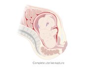 Uterine rupture - Knowledge @ AMBOSS