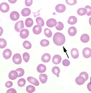 Erythrocyte morphology and hemoglobin - Knowledge @ AMBOSS