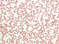 Erythrocyte morphology and hemoglobin - Knowledge @ AMBOSS