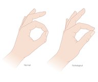 Median nerve neuropathy - Knowledge @ AMBOSS