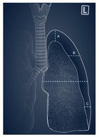 Pneumothorax - Knowledge @ AMBOSS