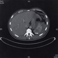 Splenic injuries - Knowledge @ AMBOSS