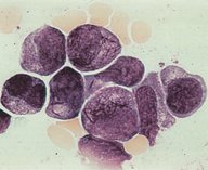 Acute leukemia - Knowledge @ AMBOSS
