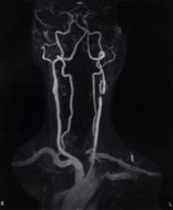 Carotid artery stenosis - Knowledge @ AMBOSS