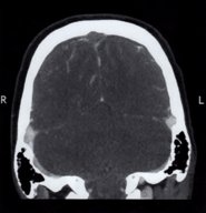 Cerebral venous thrombosis - Knowledge @ AMBOSS