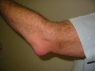 Bursitis - Knowledge @ AMBOSS