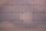 Atrial fibrillation - Knowledge @ AMBOSS