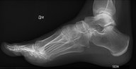 Foot deformities - Knowledge @ AMBOSS