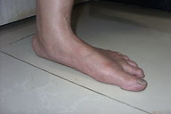 Foot deformities - Knowledge @ AMBOSS
