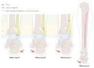 Ankle fracture - Knowledge @ AMBOSS