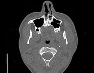 Nasal turbinate hypertrophy - Knowledge @ AMBOSS