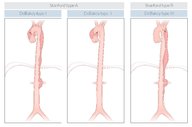 Aortic dissection - Knowledge @ AMBOSS