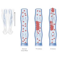 Deep vein thrombosis - Knowledge @ AMBOSS