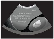 Ascites - Knowledge @ AMBOSS