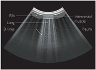 Pneumothorax - Knowledge @ AMBOSS