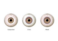 Overview of conjunctivitis - Knowledge @ AMBOSS