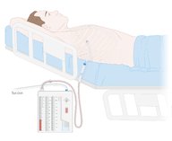 Chest tube placement - Knowledge @ AMBOSS