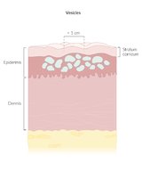 Principles of dermatology - Knowledge @ AMBOSS