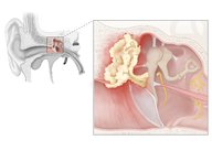 Cholesteatoma - Knowledge @ AMBOSS