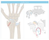 Forearm fractures - Knowledge @ AMBOSS