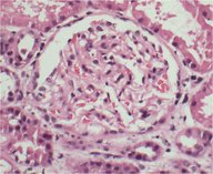 Nephrotic syndrome - Knowledge @ AMBOSS