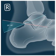Calcaneal fracture - Knowledge @ AMBOSS