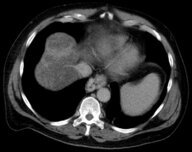 Esophageal varices - Knowledge @ AMBOSS